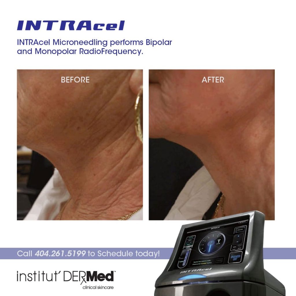 NEW – INTRAcel Fractional RF Microneedling Treatment – Institut Dermed
