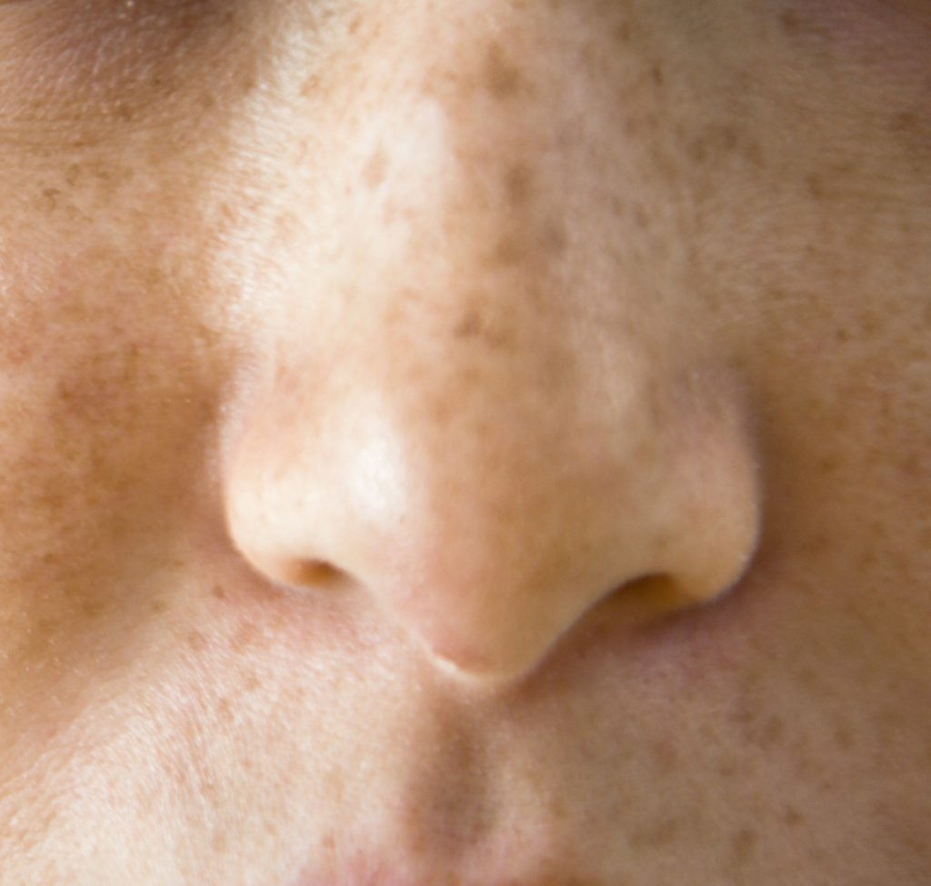 Treating Photo-Aging with Micro-needling and Peels – Institut Dermed